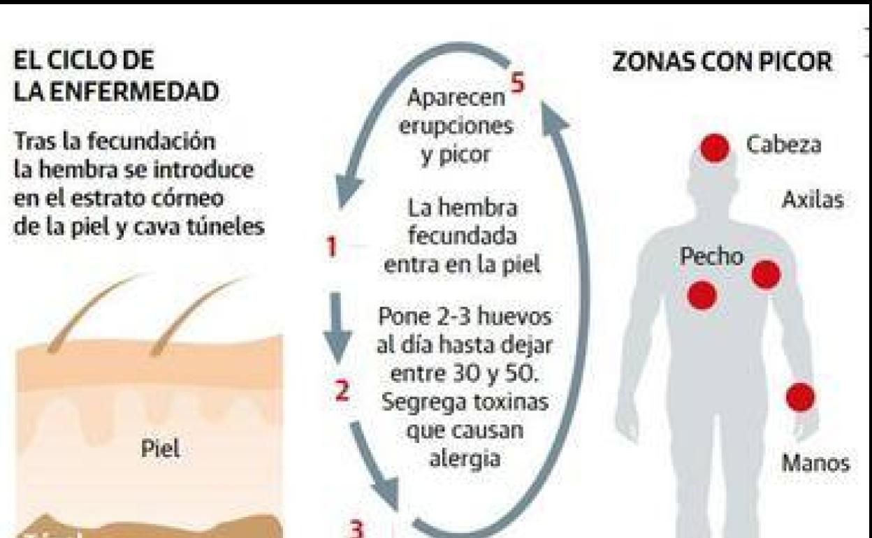 Qu Es La Sarna O Escabiosis Sntomas De La Sarna